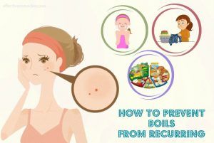 10 Tips How To Get Rid Of Boils On Face, Back, Butt, Thigh, Feet