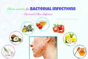 47 Home Remedies For Bacterial Infections On Skin Blood Mouth