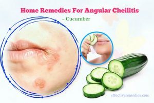 20 Home Remedies For Angular Cheilitis (Cracks In Mouth Corners)