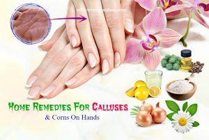 31 Effective Home Remedies For Calluses & Corns On Hands & Feet