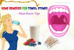24 Effective Home Remedies For Tonsil Stones In Adults & Children